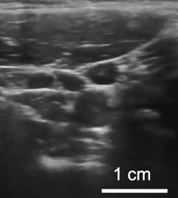 Elastomer engineering finally gets deep images from skin patch ... Elastomer engineering finally gets deep images from skin patch ...
