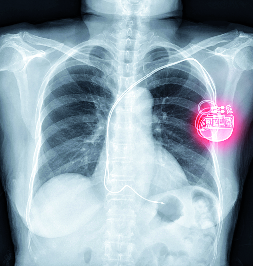 Performance Gets A Reboot With Partitioning Using Reram Electronics